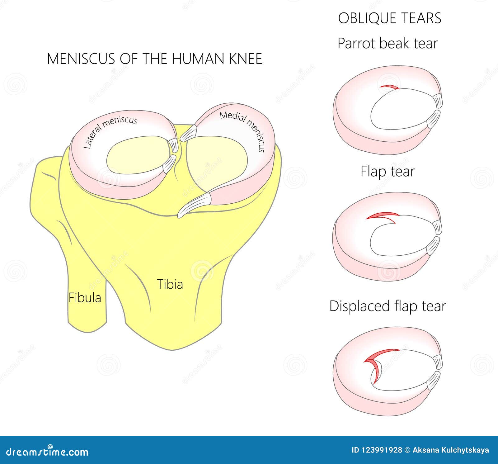 Meniskus _Oblique Risse vektor abbildung. Illustration von diagramm ...