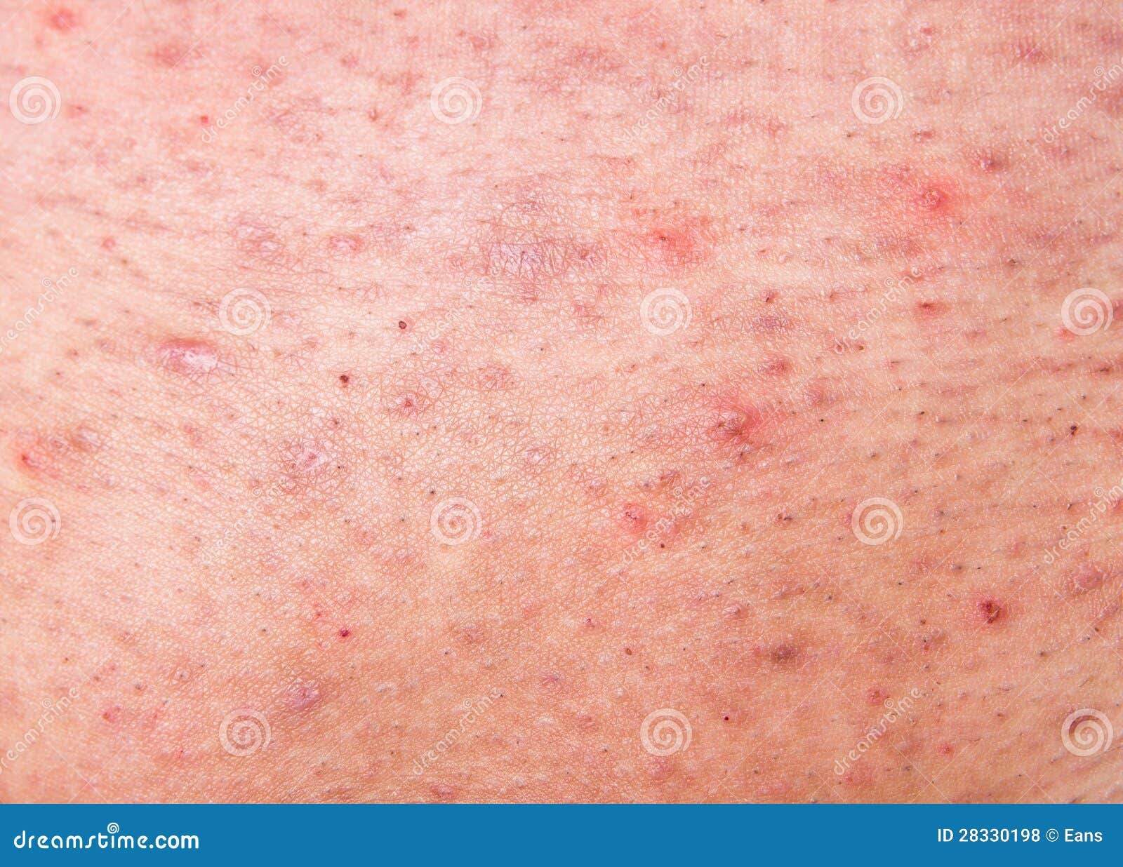 Menschliche Haut mit Akne stockfoto. Bild von juckreiz - 28330198