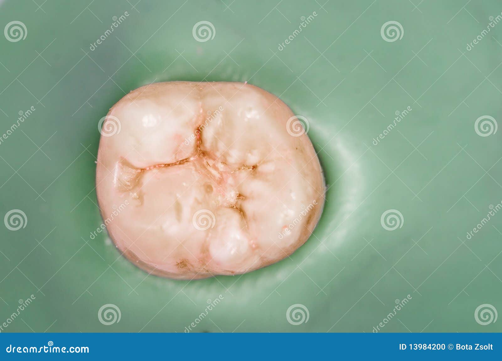 Menschlicher Zahn - Karies stockfoto. Bild von gesund - 13984200