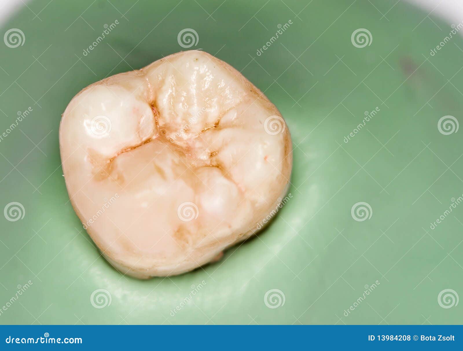 Menschlicher Zahn - Karies stockfoto. Bild von makro - 13984208