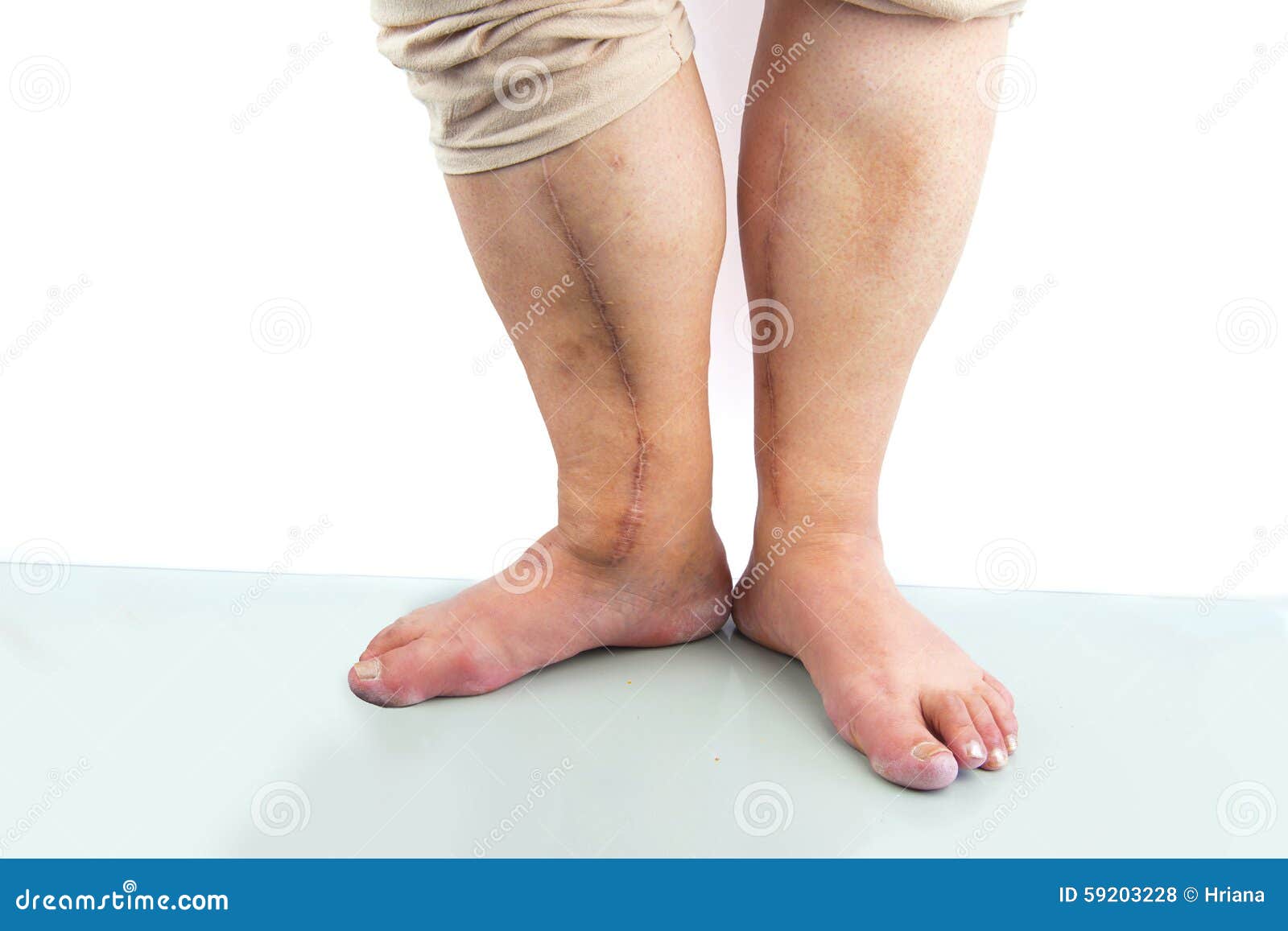 Menselijk Been Met Postoperatief Litteken Van Hartchirurgie Stock Foto ...