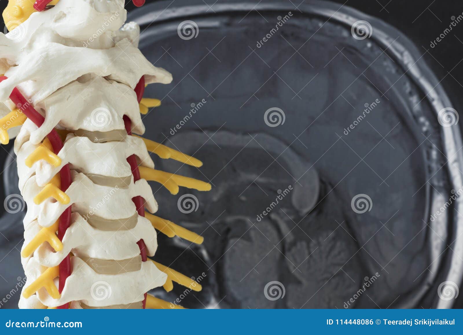 Menselijk Cervicaal Stekelmodel En Hersenenmri Beeld Stock Foto - Image ...