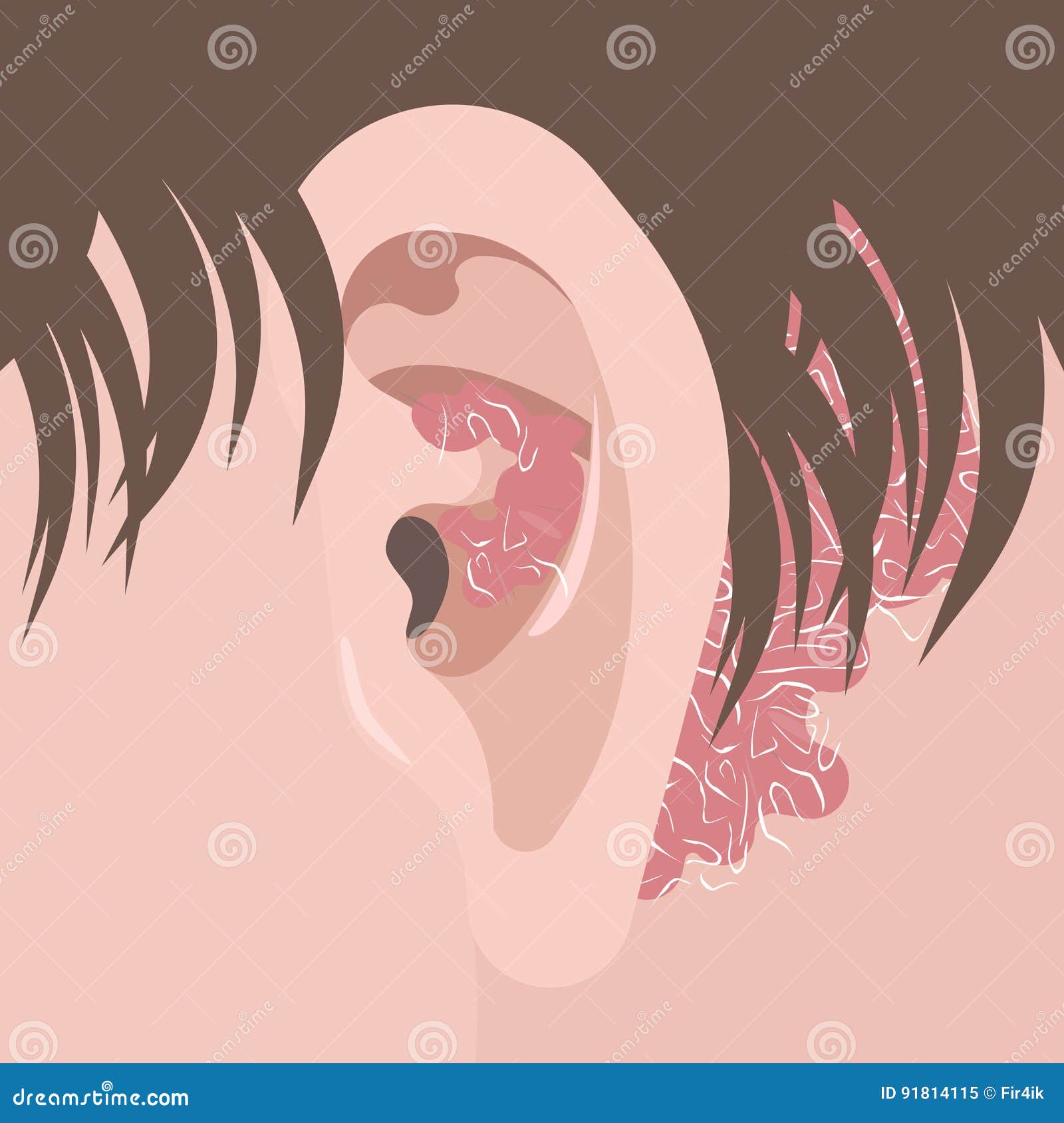 Menselijk Hals En Oor Met Psoriasis Vector Illustratie - Illustration ...