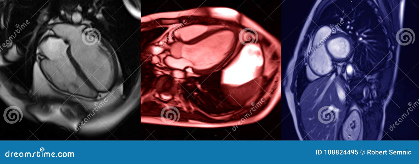 Menselijk hart, MRI-beeld stock afbeelding. Image of slagader - 108824495