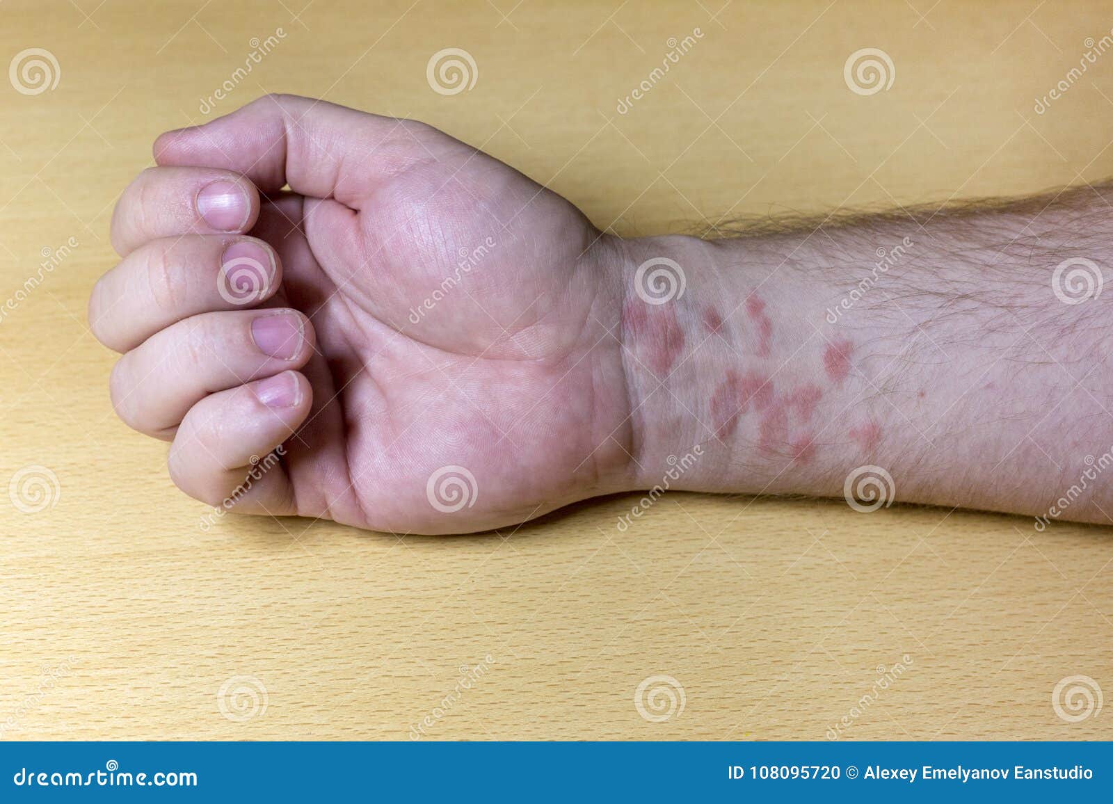 Menselijke Huid in Rode Vlekken Stock Foto - Image of psoriasis, huid ...
