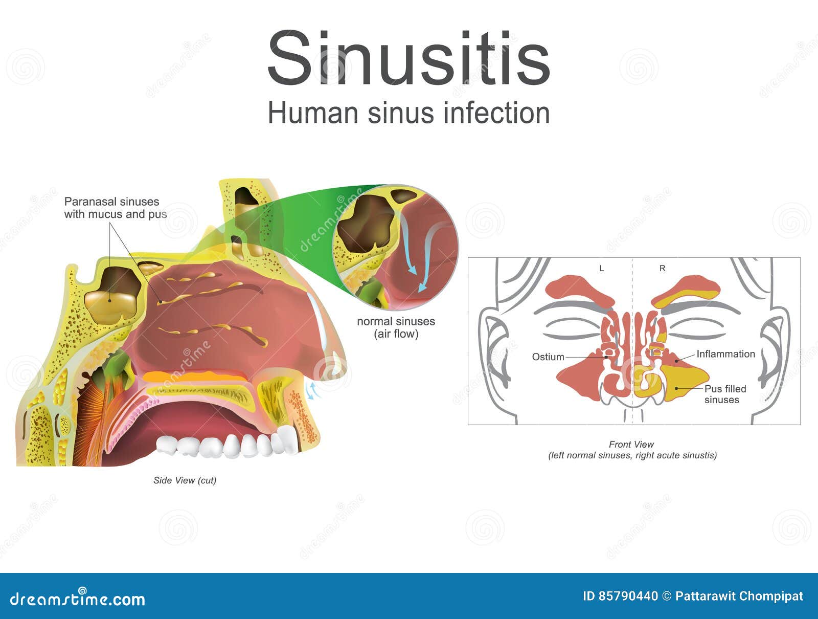 Menselijke Sinusitis, Ontsteking Illustratie, Vectorart. Vector ...