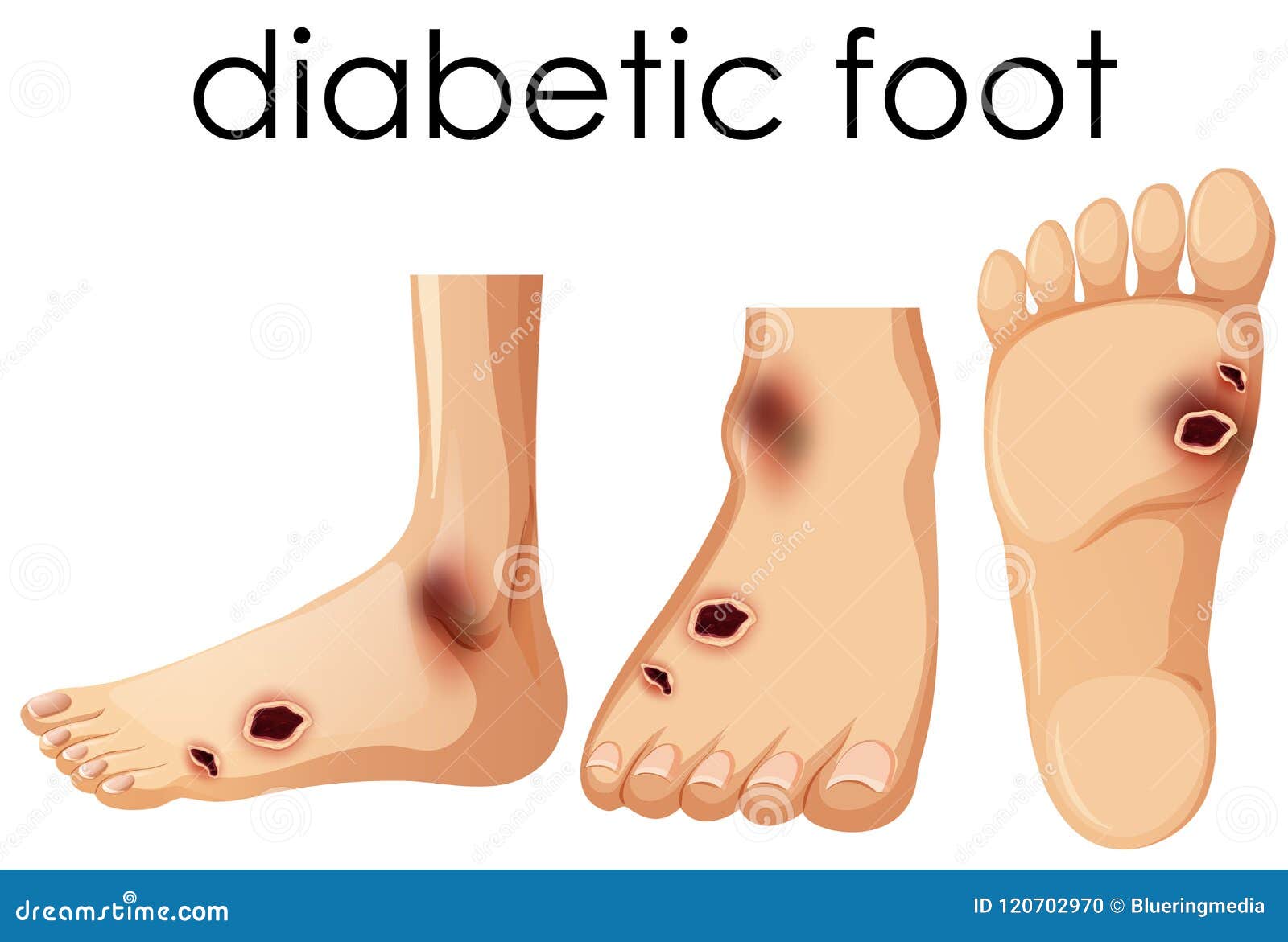 Menselijke Voet Met Diabeticus Vector Illustratie - Illustration of ...