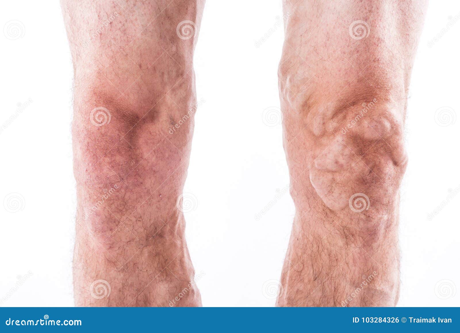 Mensen Met Spataders Van De Lagere Uitersten En Aderlijk T Stock Foto ...