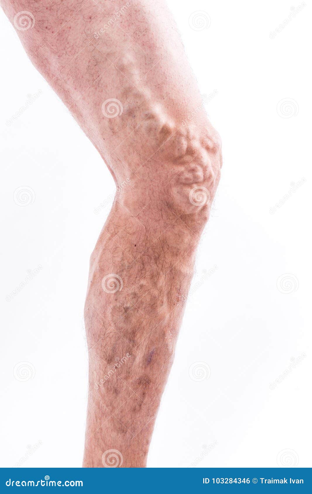 Mensen Met Spataders Van De Lagere Uitersten En Aderlijk T Stock Foto ...