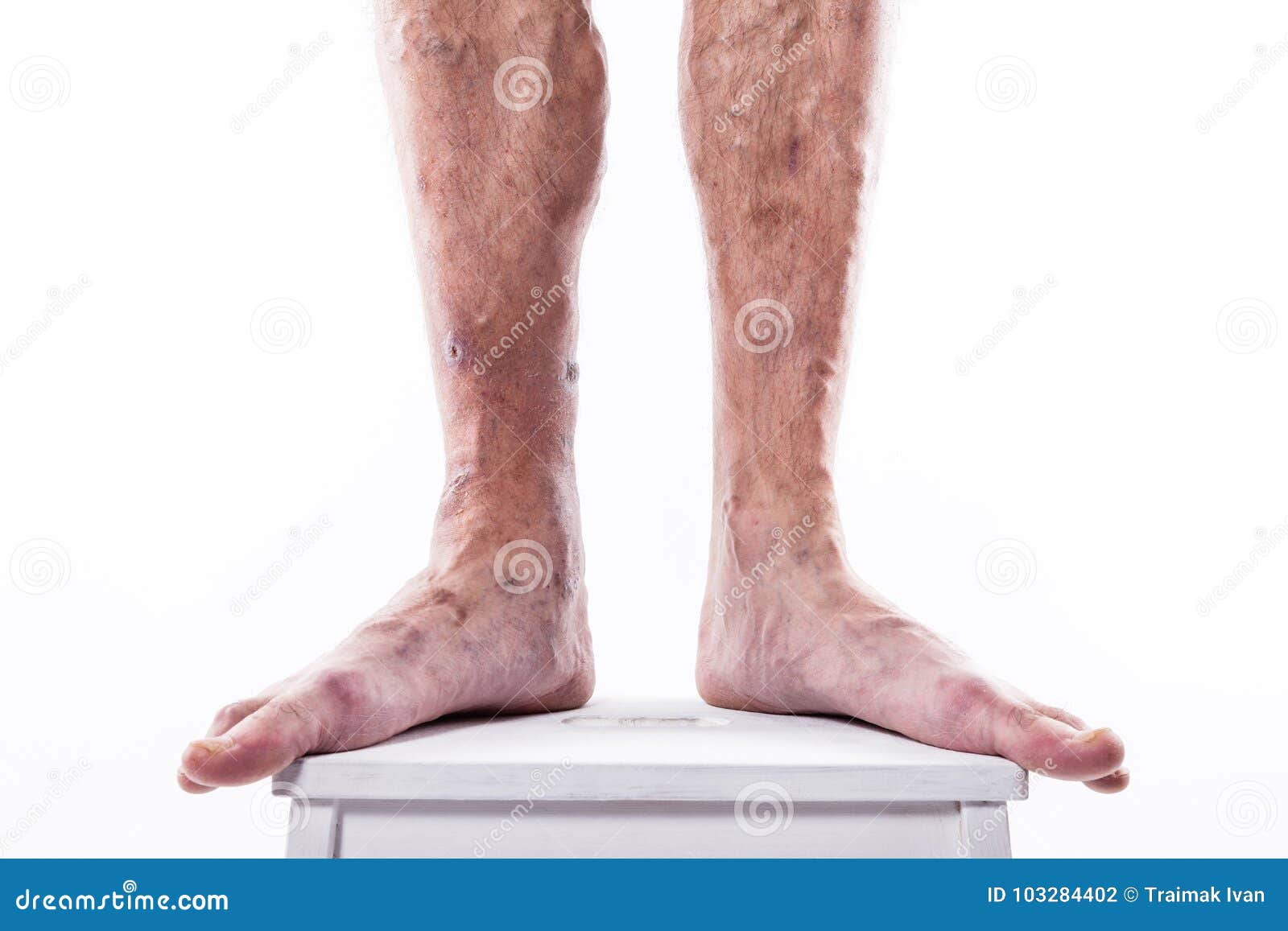 Mensen Met Spataders Van De Lagere Uitersten En Aderlijk T Stock Foto ...