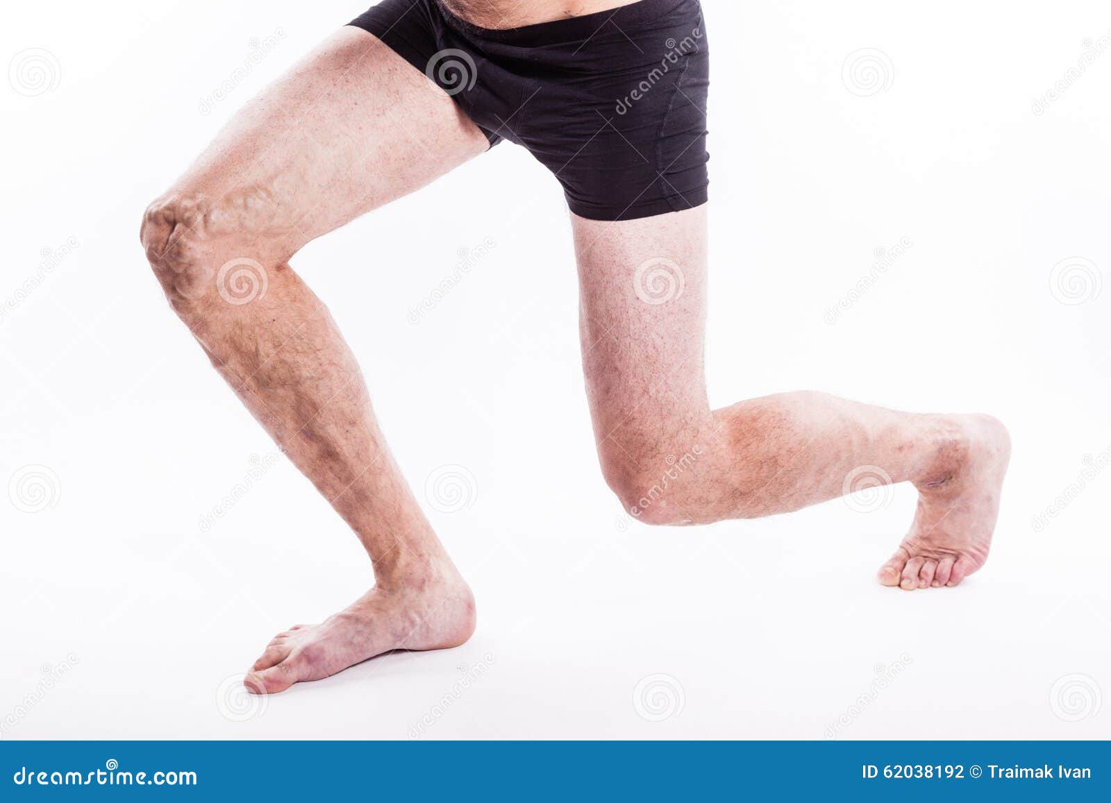 Mensen Met Spataders Van De Lagere Uitersten En Aderlijk T Stock Foto ...