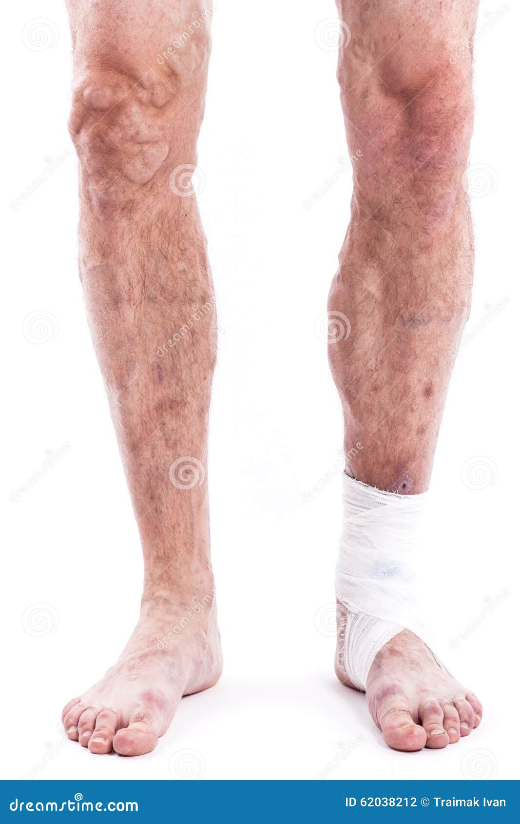 Mensen Met Spataders Van De Lagere Uitersten En Aderlijk T Stock Foto ...