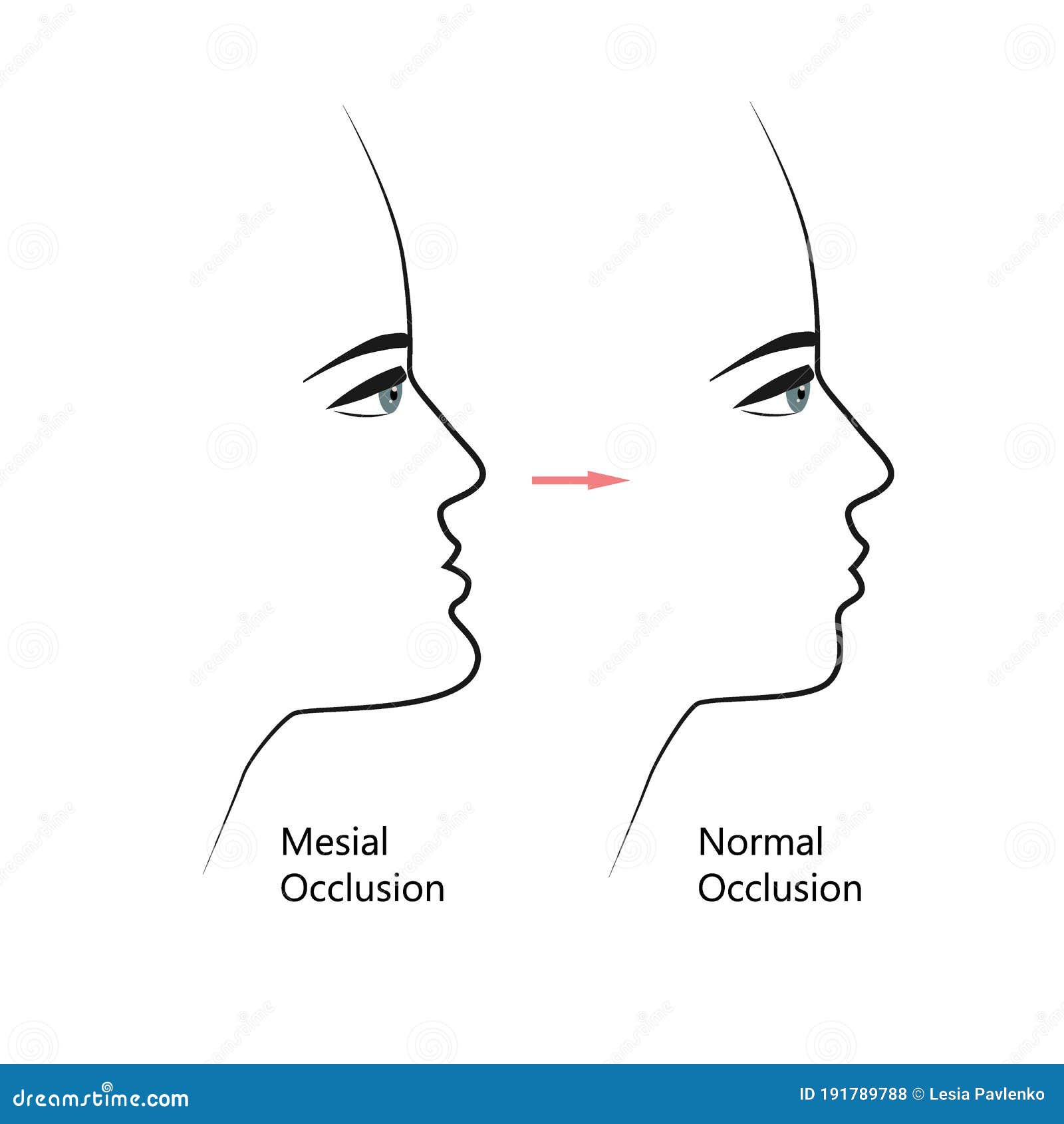 Mesial Bite Profile Before And After Orthodontic Treatment. Human With ...