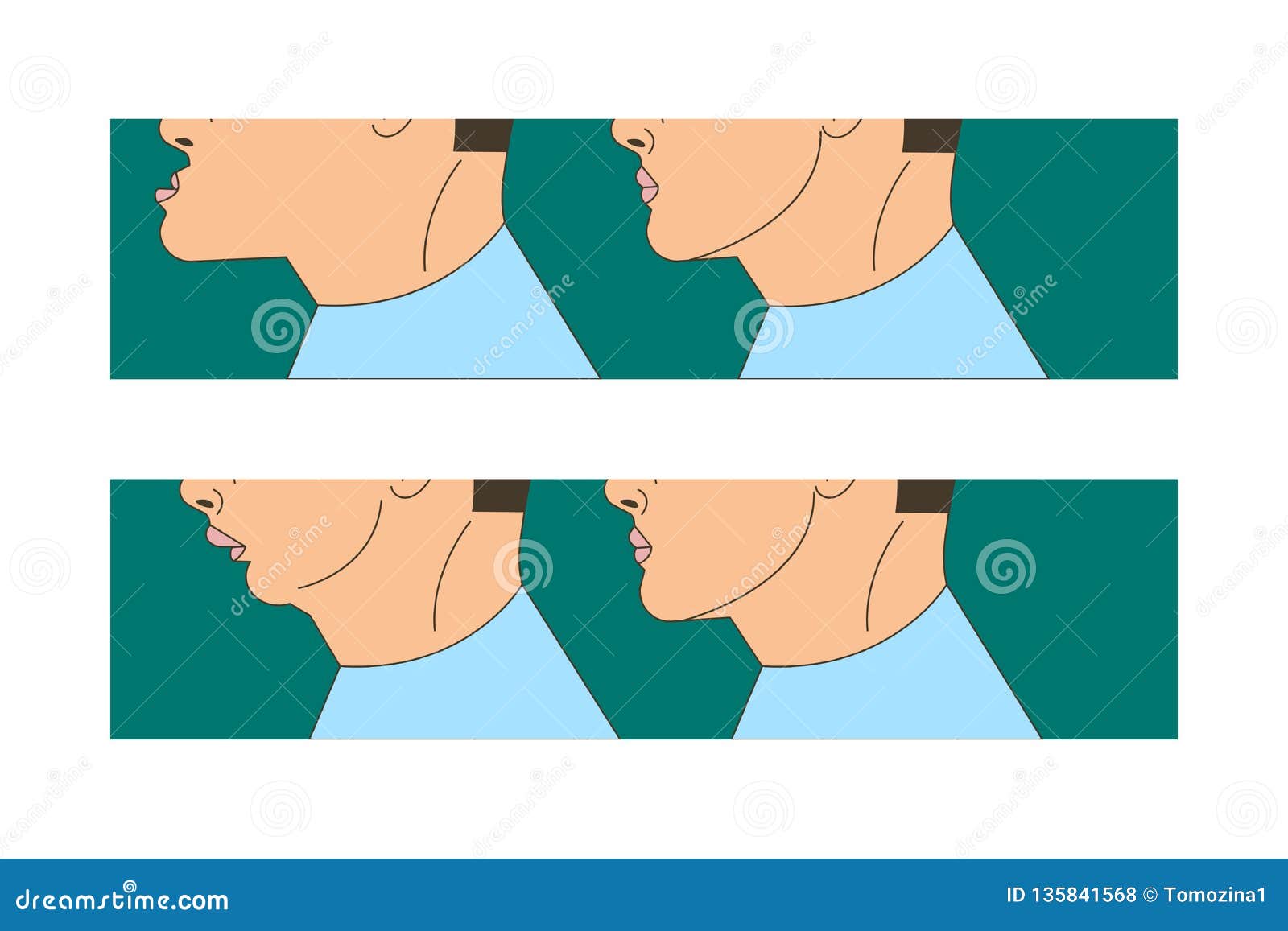 Mesial Bite Profile Before And After Orthodontic Treatment. Human With ...