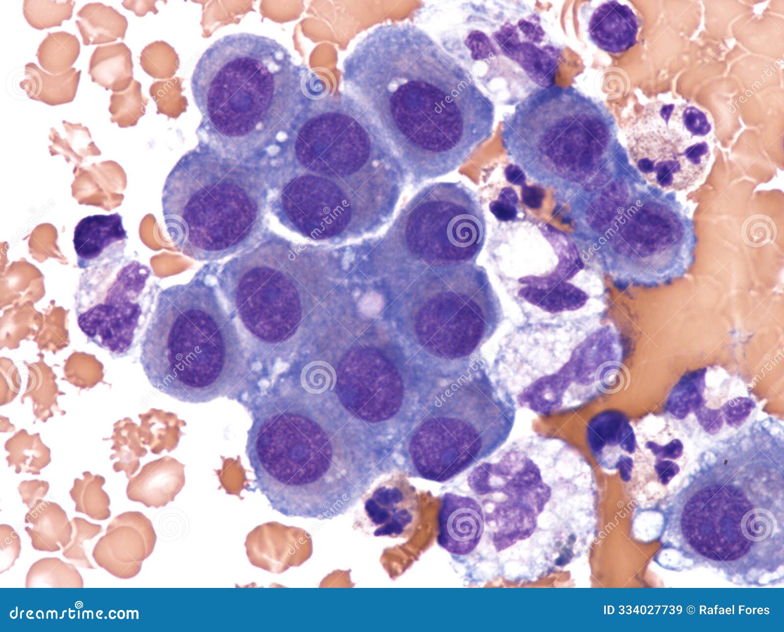 Mesothelial Cells In Pleural Fluid Stock Image Image Of Hyperplasia Cavities 334027739