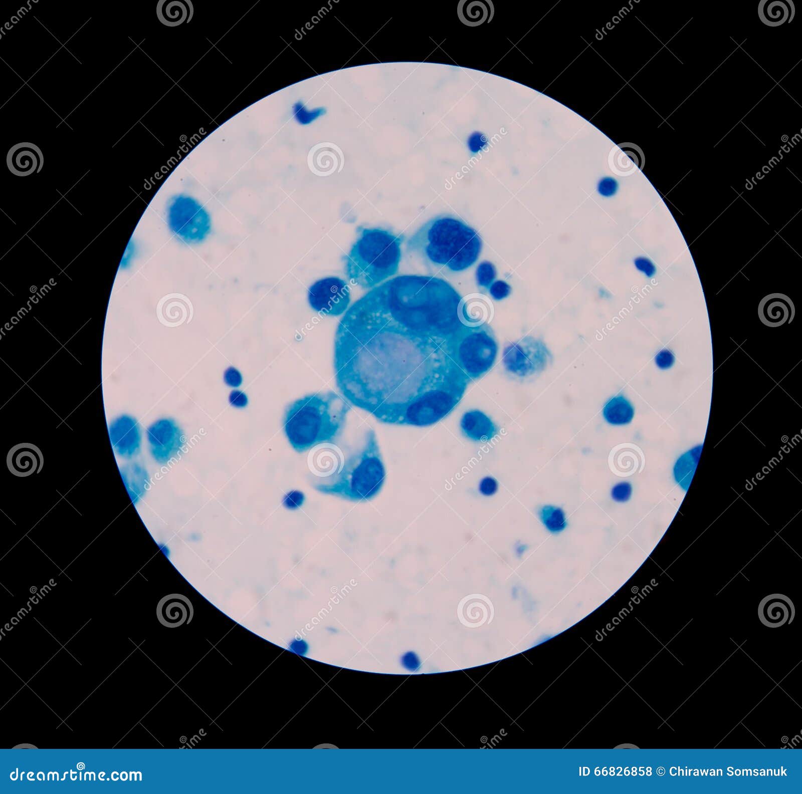 Mesothelial Malignant Cells with Multiple Nuclei Stock Photo - Image of ...