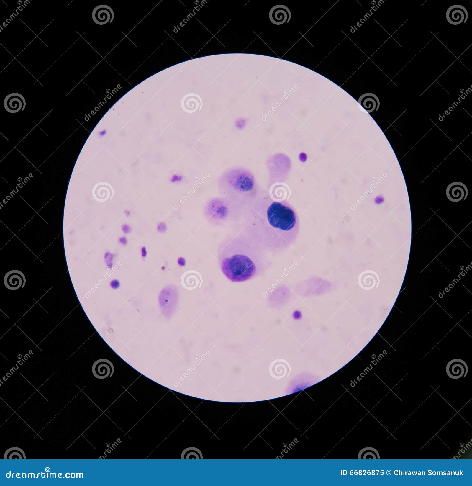 Mesothelial Malignant Cells with Multiple Nuclei Stock Image - Image of ...