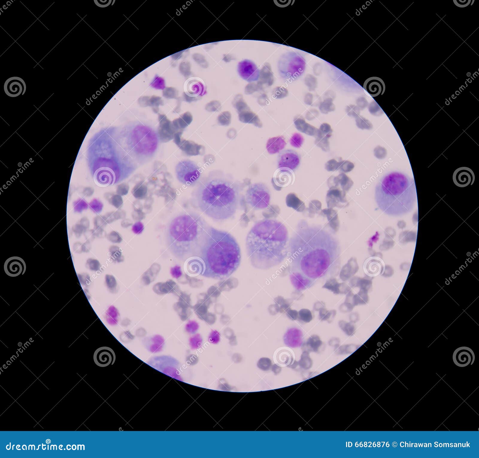 Malignant Cells, Photo Under Microscope Royalty-Free Stock Image ...