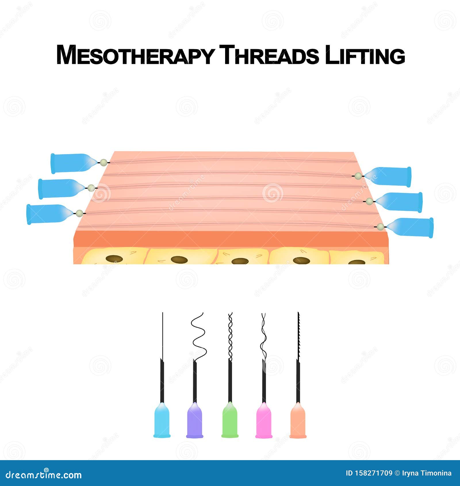 Mesotherapy Threads Lifting. Different Types Of Threads For Facelift ...