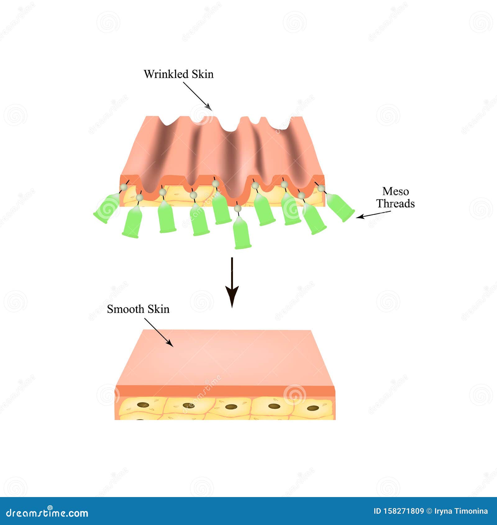 Mesotherapy Threads Lifting. Threads For Facelift. The Structure Of The ...