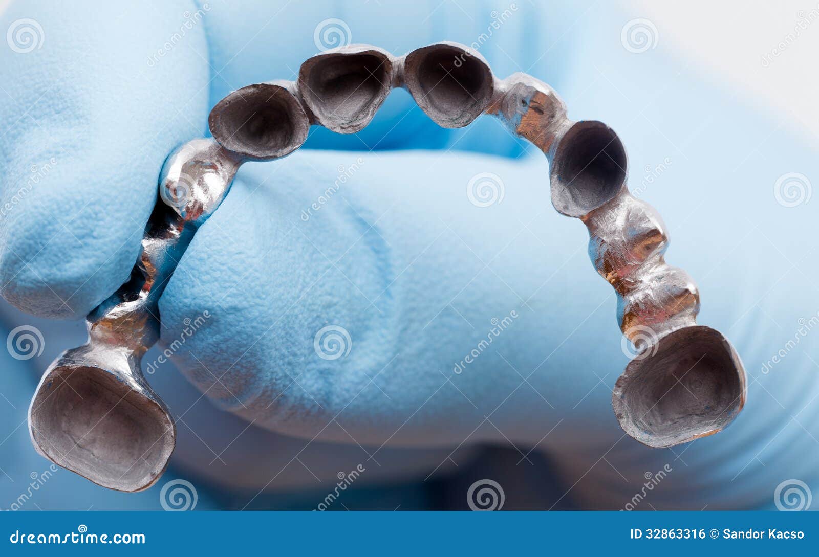 Metal Denture. Arch Prosthetics. False Teeth. Clammer Upper Removable ...