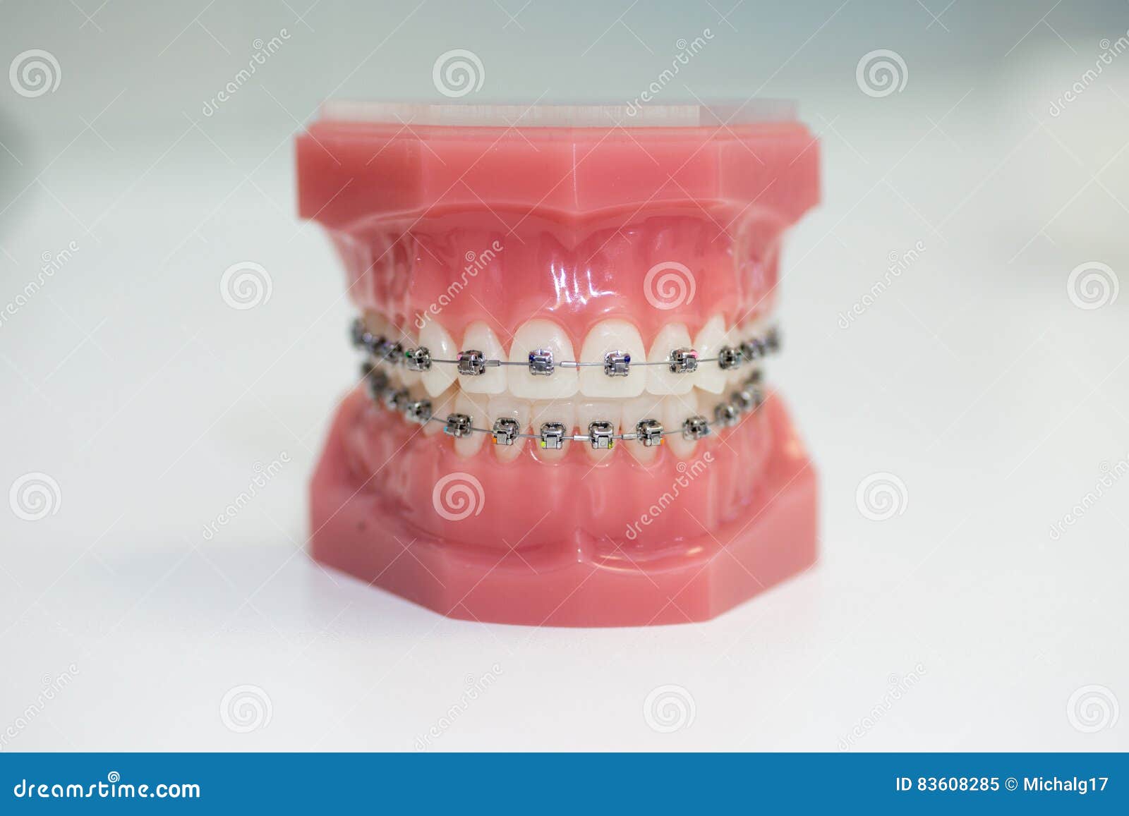 Metal Braces, Orthodontic Model Stock Image - Image of models ...