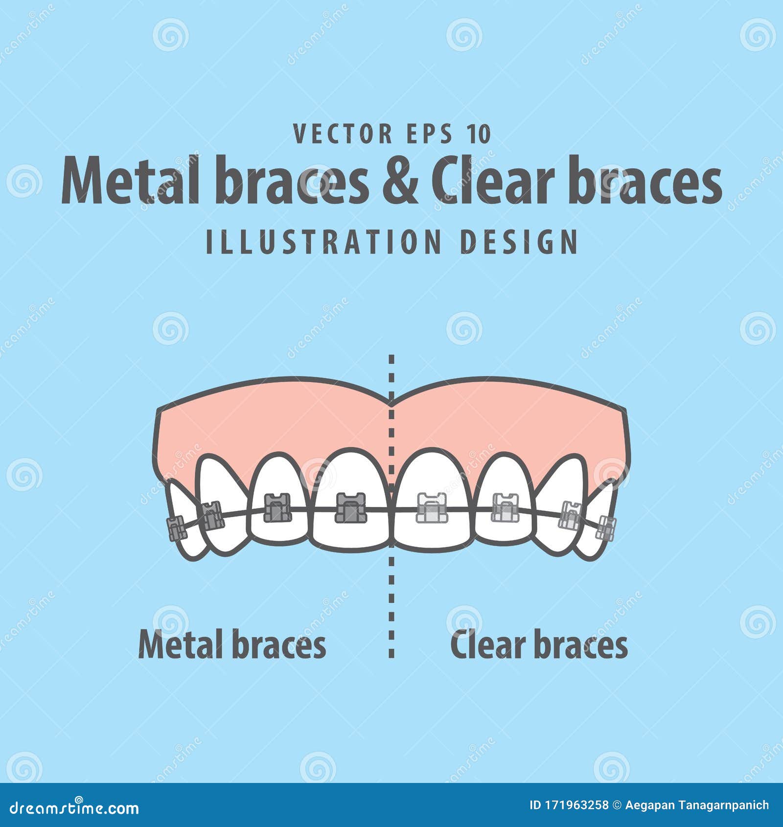 Metal Braces Teeth And Clear Braces Teeth Upper Comparison Illustration