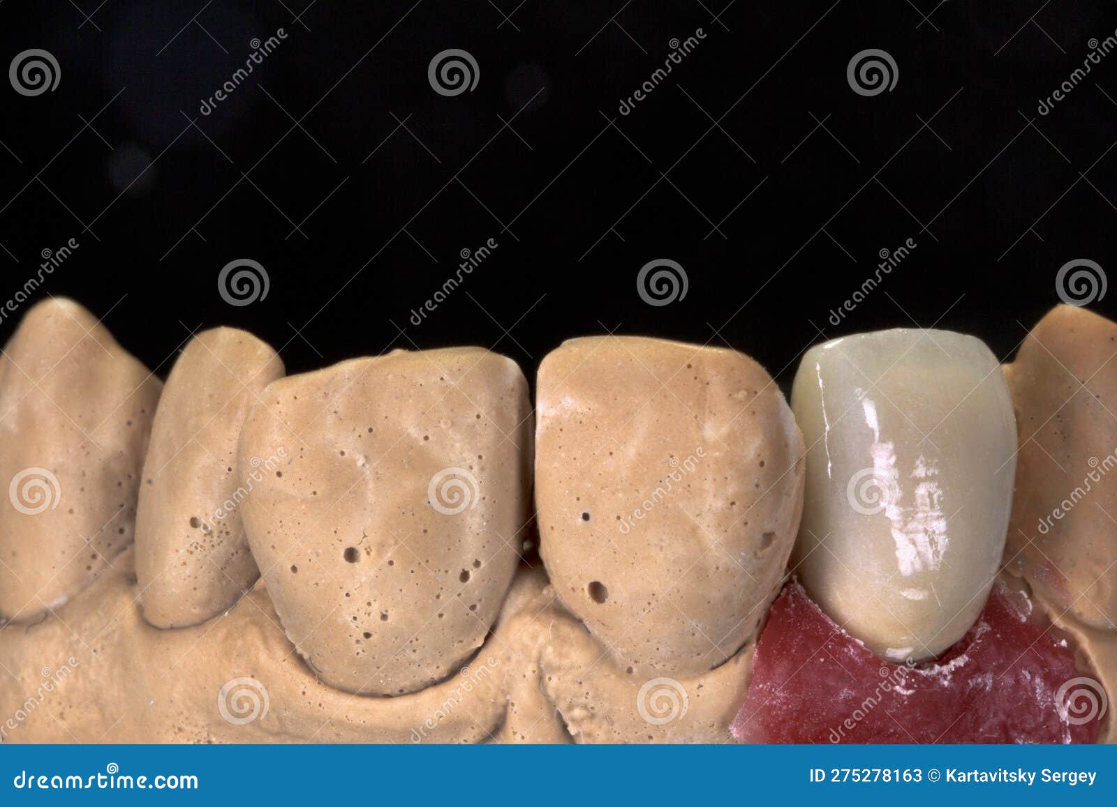 Metal Ceramic Bridge Tooth Unit Royalty-Free Stock Photography ...