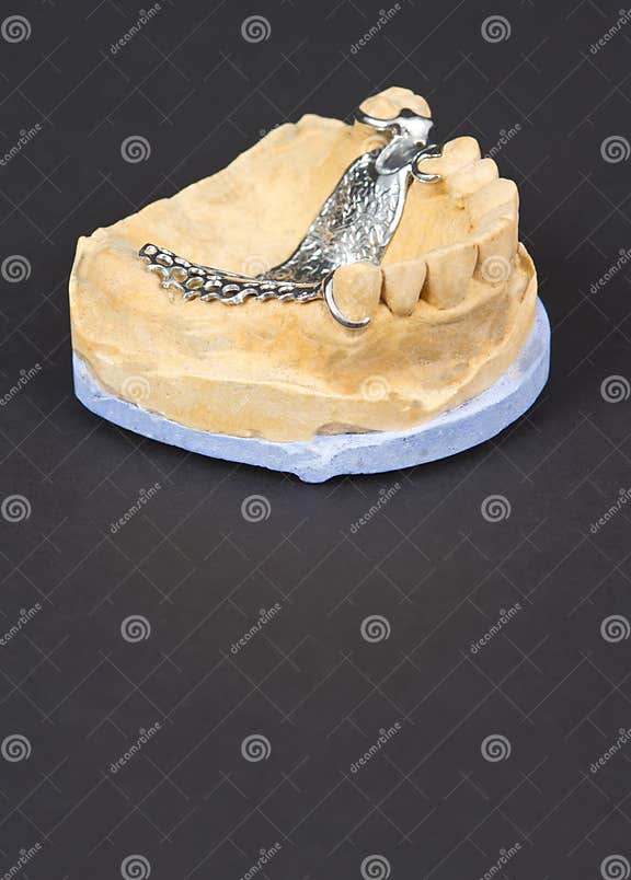 Metal Framework of a Partial Prothesis Stock Photo - Image of ...