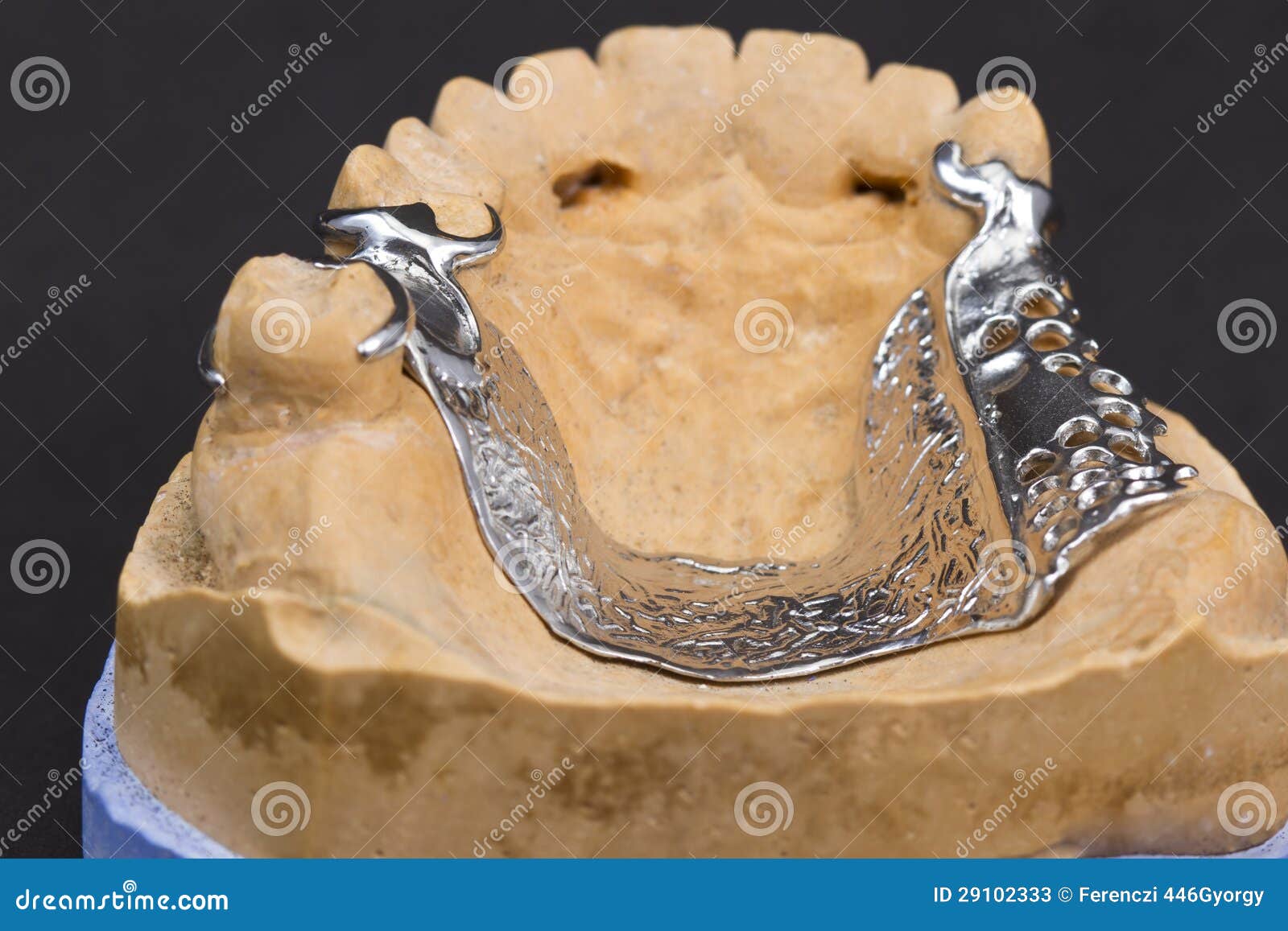 Metal Framework for a Prosthesis Stock Image - Image of prosthesis ...