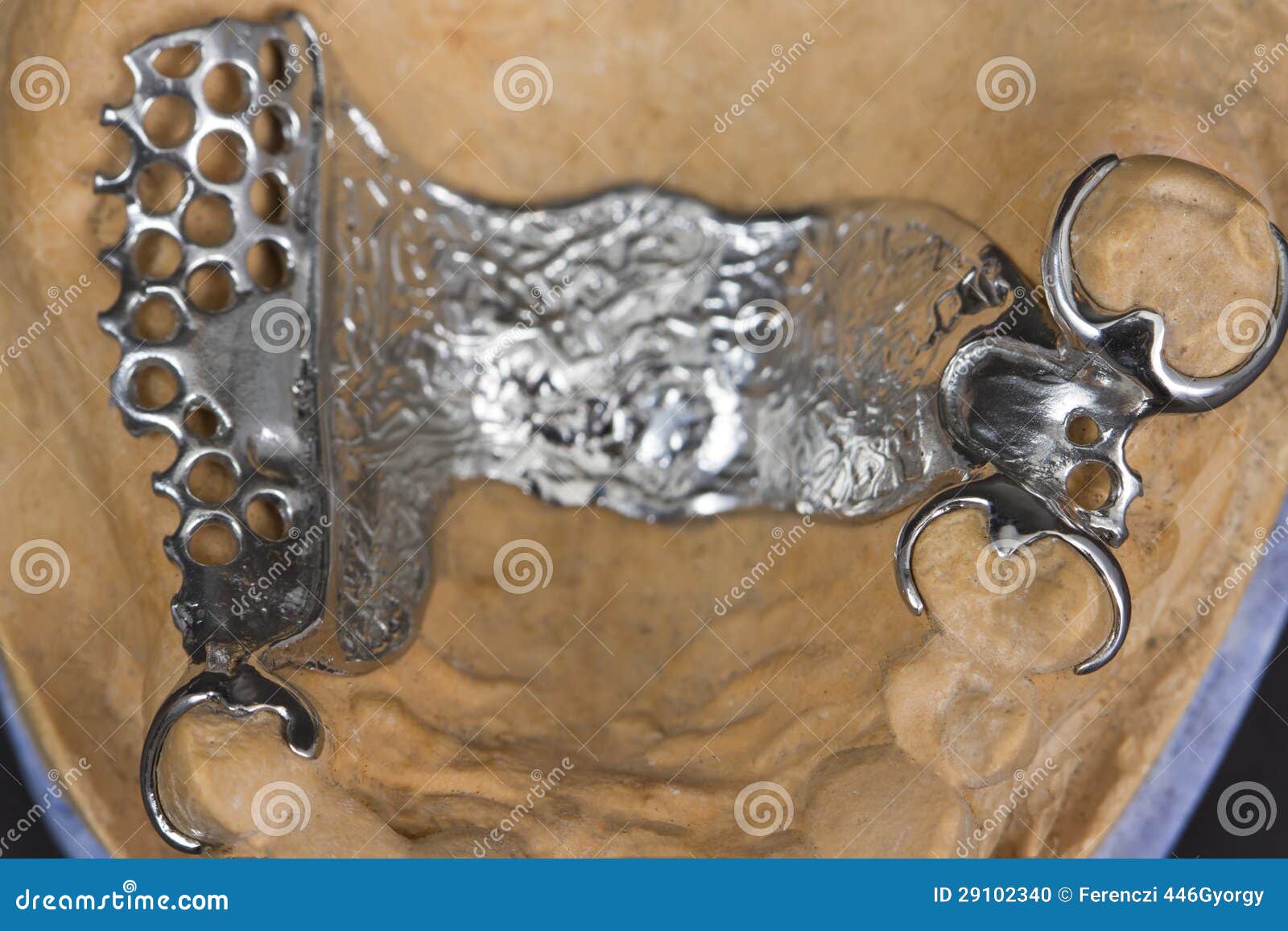 Metal Framework for a Prosthesis Stock Photo - Image of artificial ...