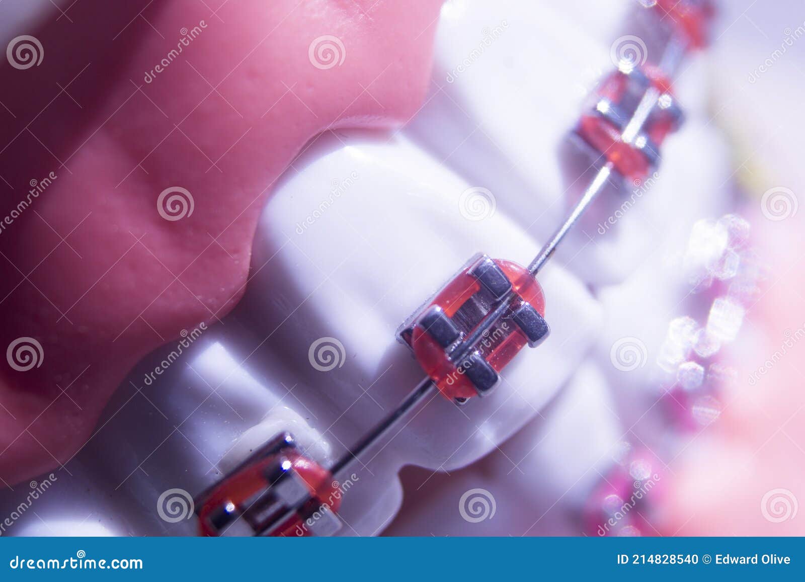 Metal teeth brackets stock photo. Image of modern, bracket - 214828540