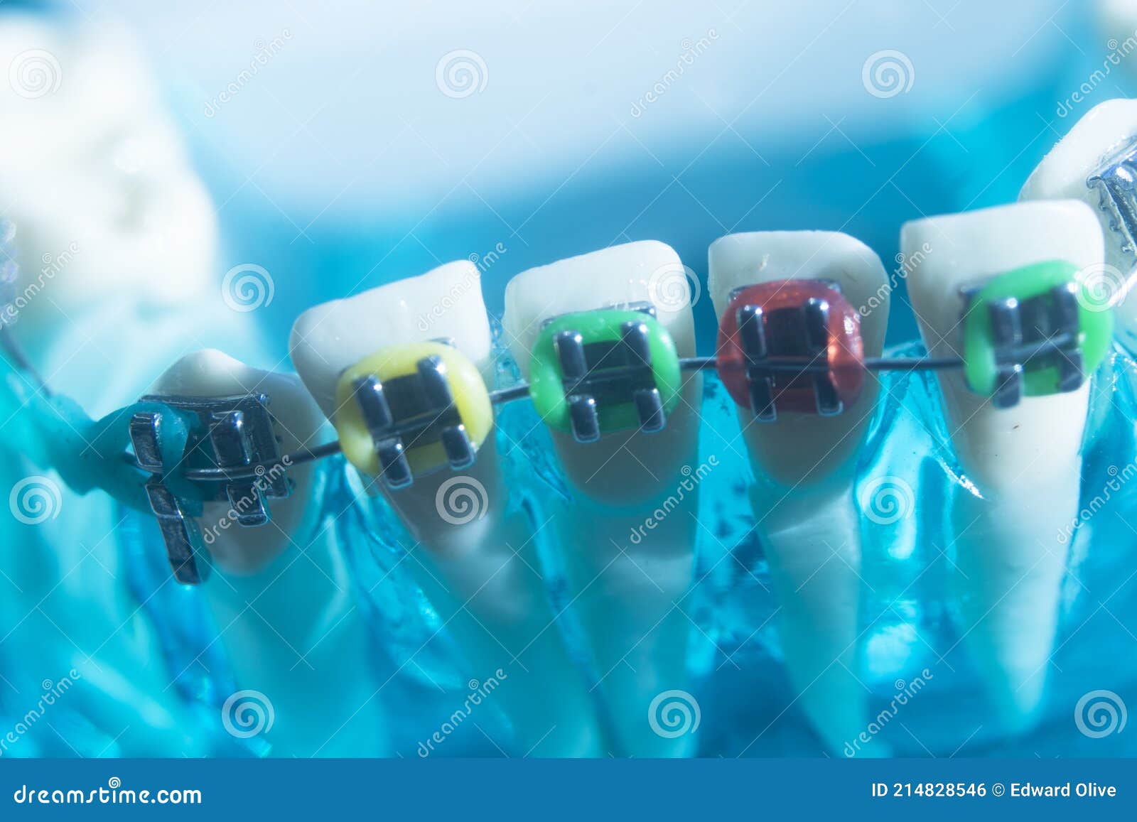 Metal teeth brackets stock photo. Image of plastic, equipment - 214828546