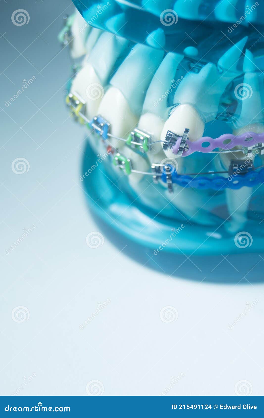 Metal teeth brackets stock photo. Image of removable - 215491124