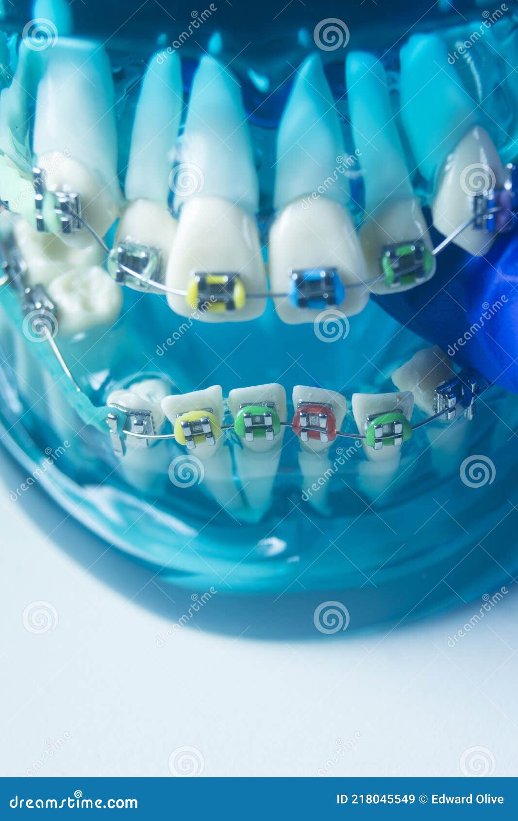 Metal teeth brackets stock image. Image of braces, clear - 218045549