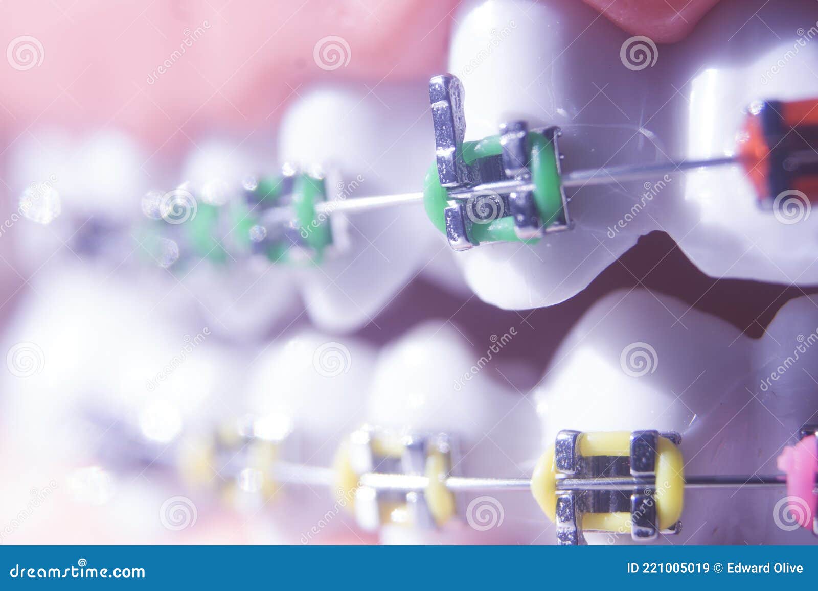 Metal teeth brackets stock image. Image of orthodontics - 221005019