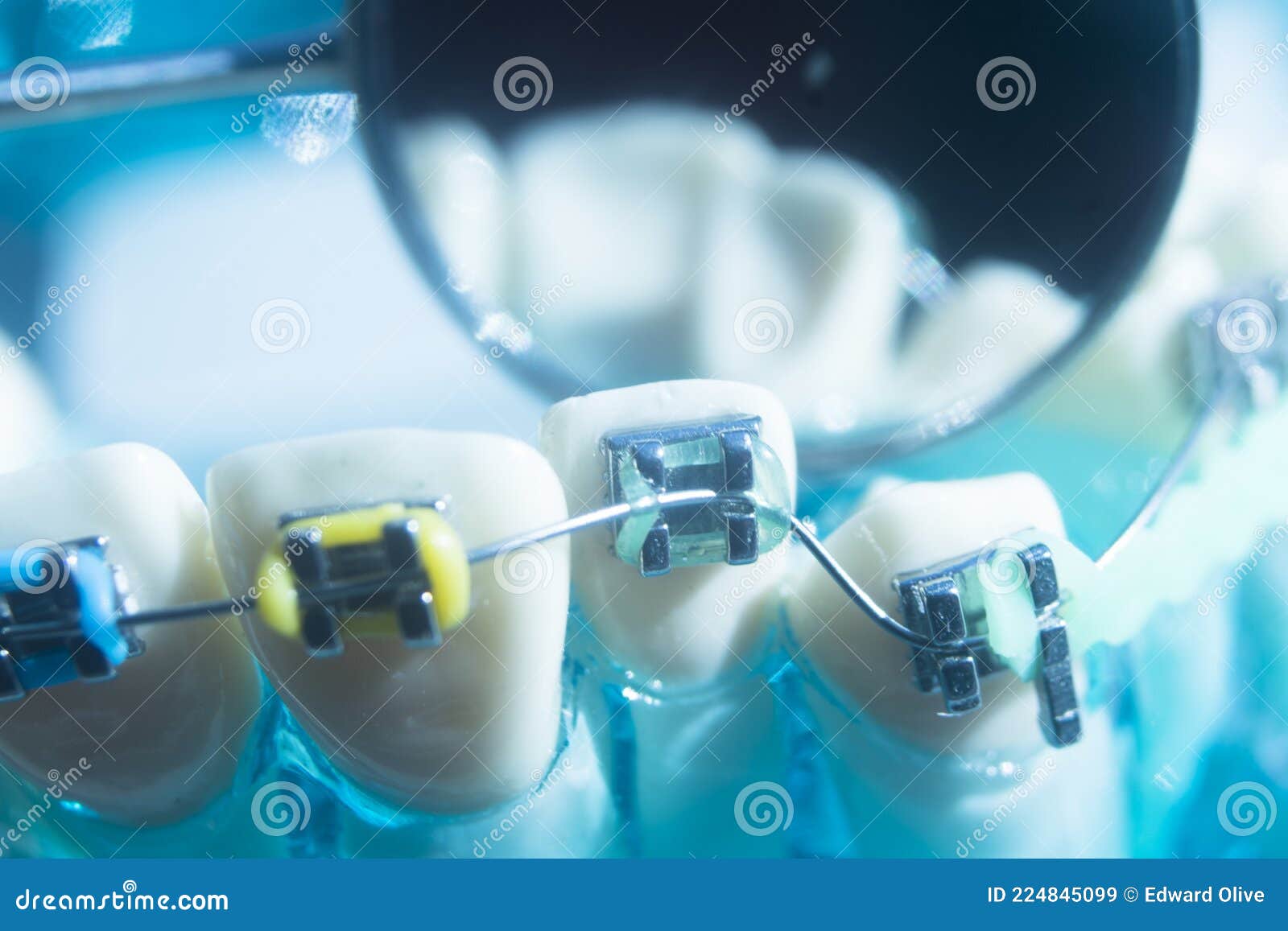 Metal teeth brackets stock image. Image of mouth, plastic - 224845099