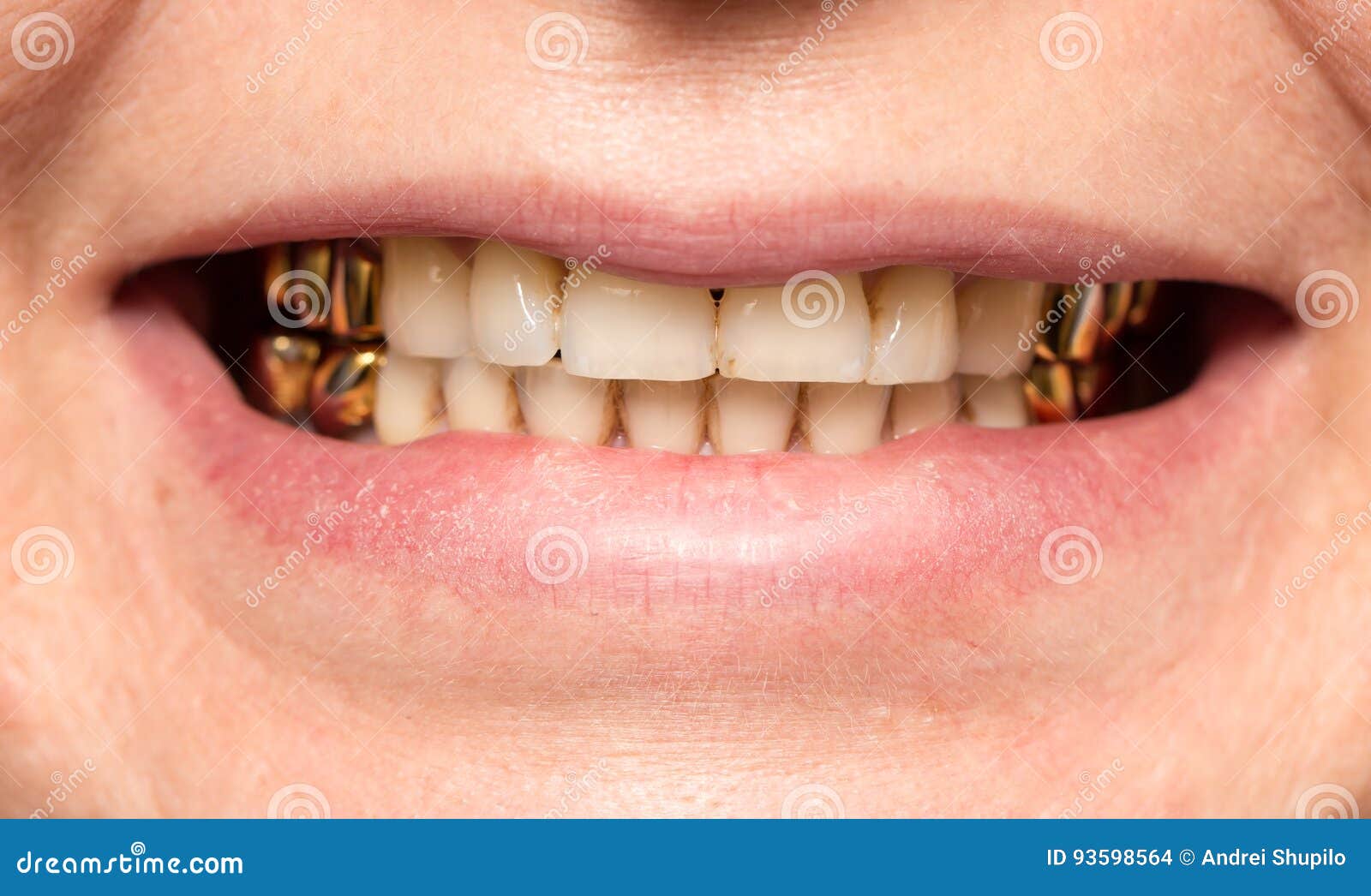 Metal teeth in the mouth stock photo. Image of brown - 93598564