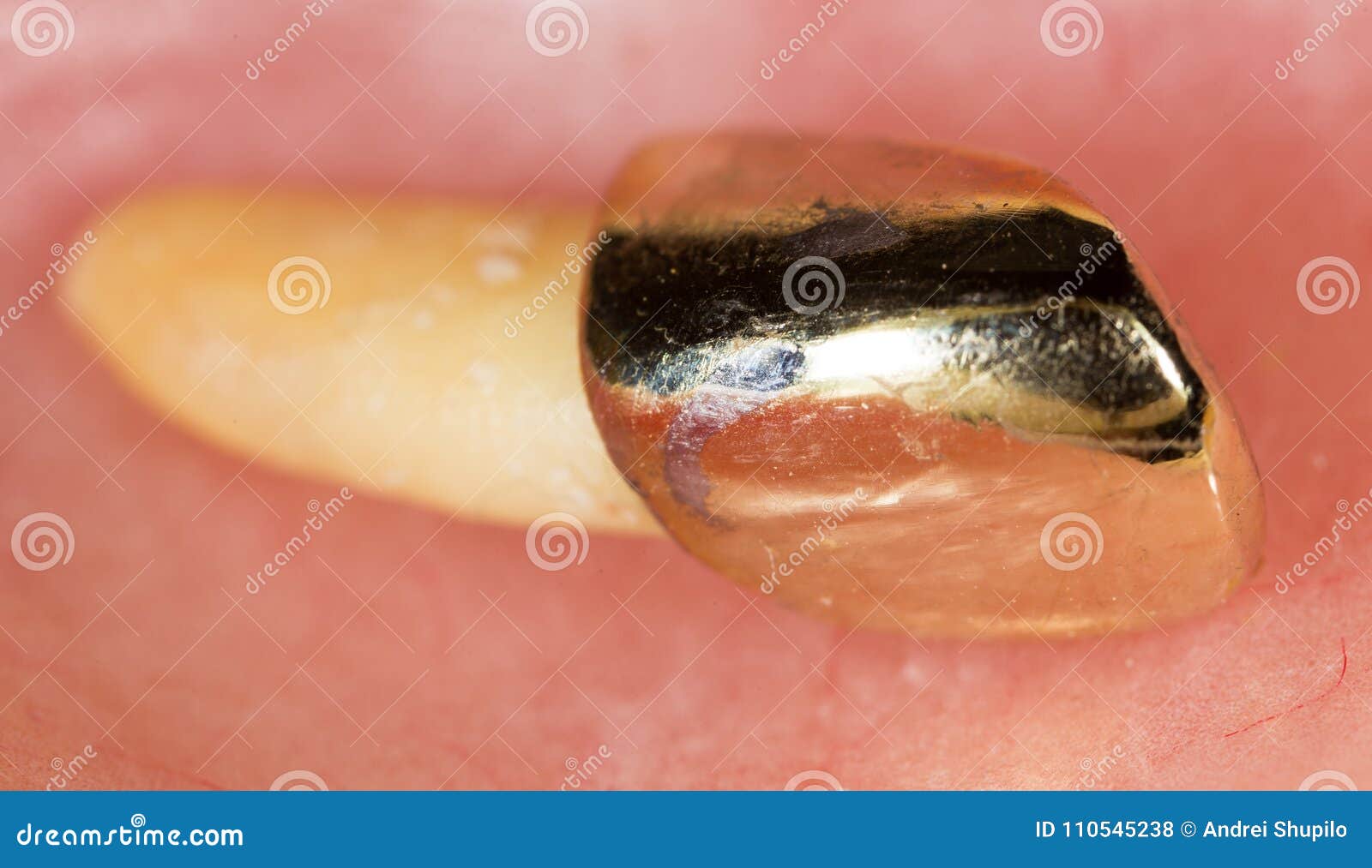Metal tooth. macro stock photo. Image of care, medical - 110545238
