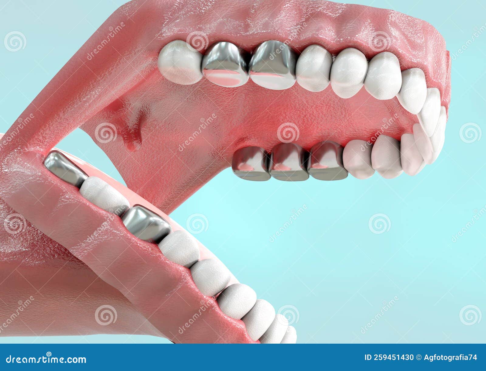 Metallic Crown Prosthesis Replacing Natural Human Tooth Stock ...