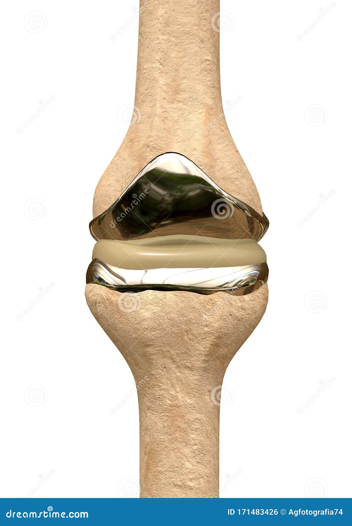 Metallic Knee Prosthesis Replacing Bone Structures Worn by Osteoporosis ...