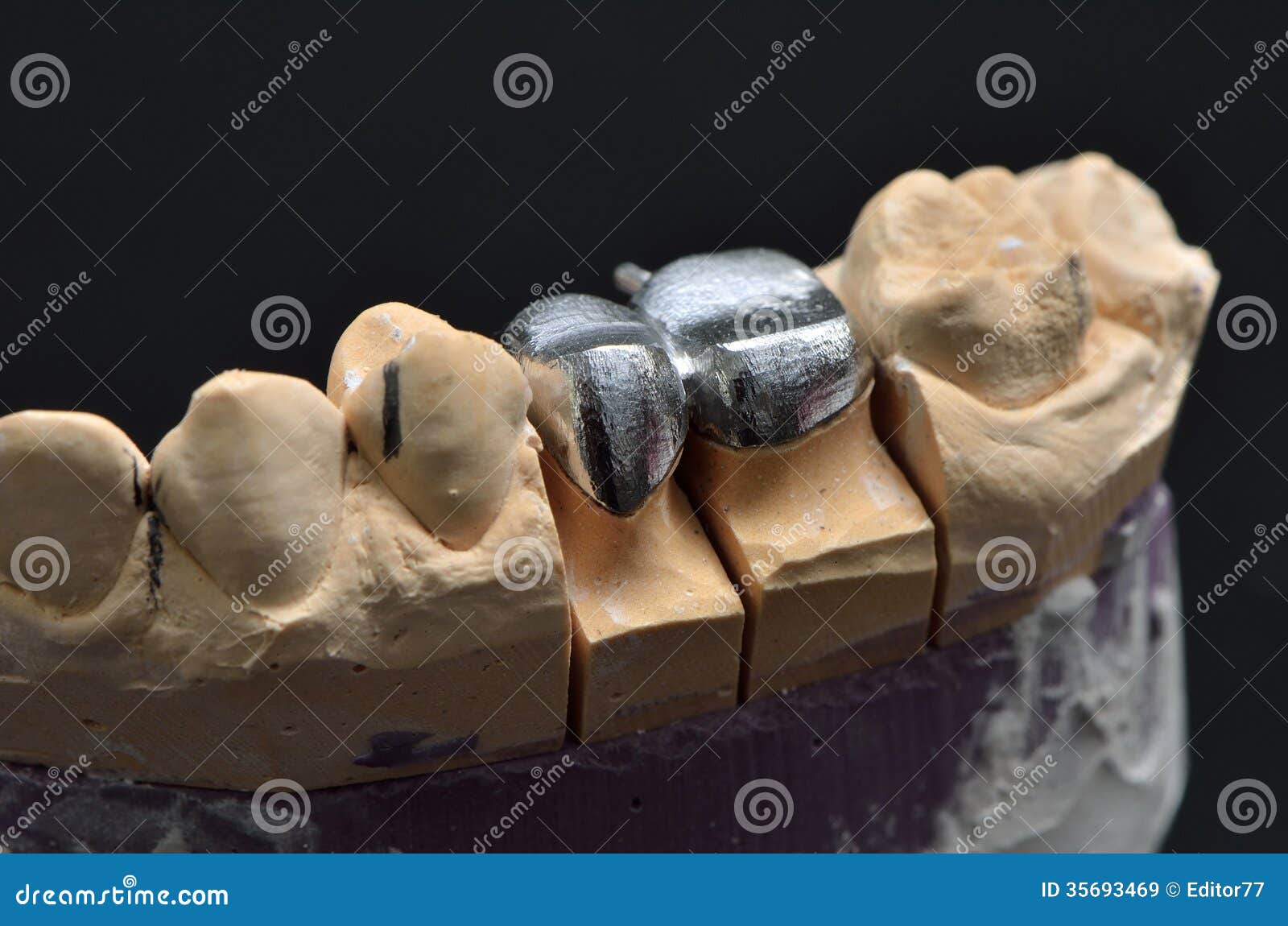 Metallic Teeth Models Implants Stock Image - Image of doctor, dental ...