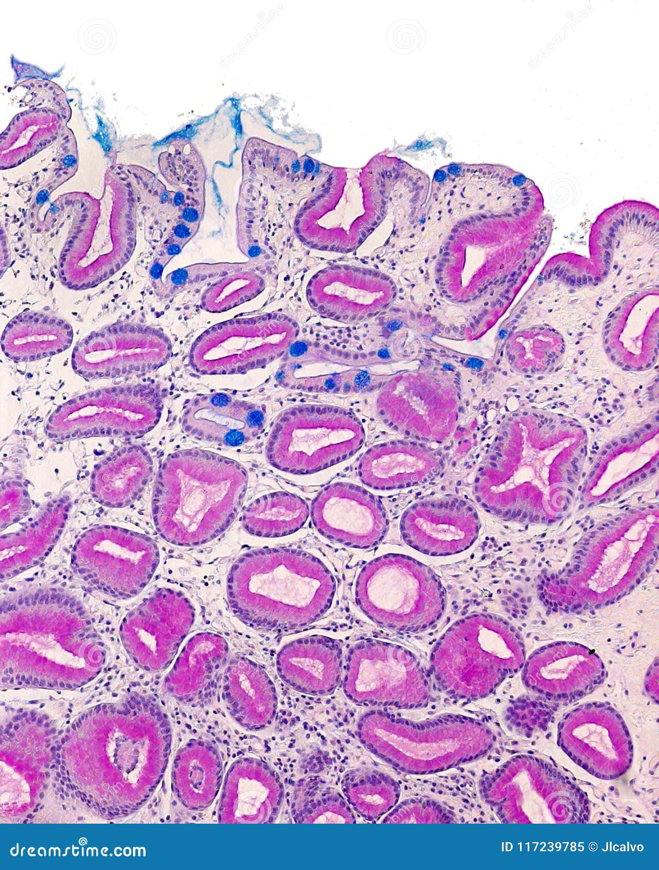 Metaplasia Intestinal De Muqueuse Gastrique Image stock - Image du ...