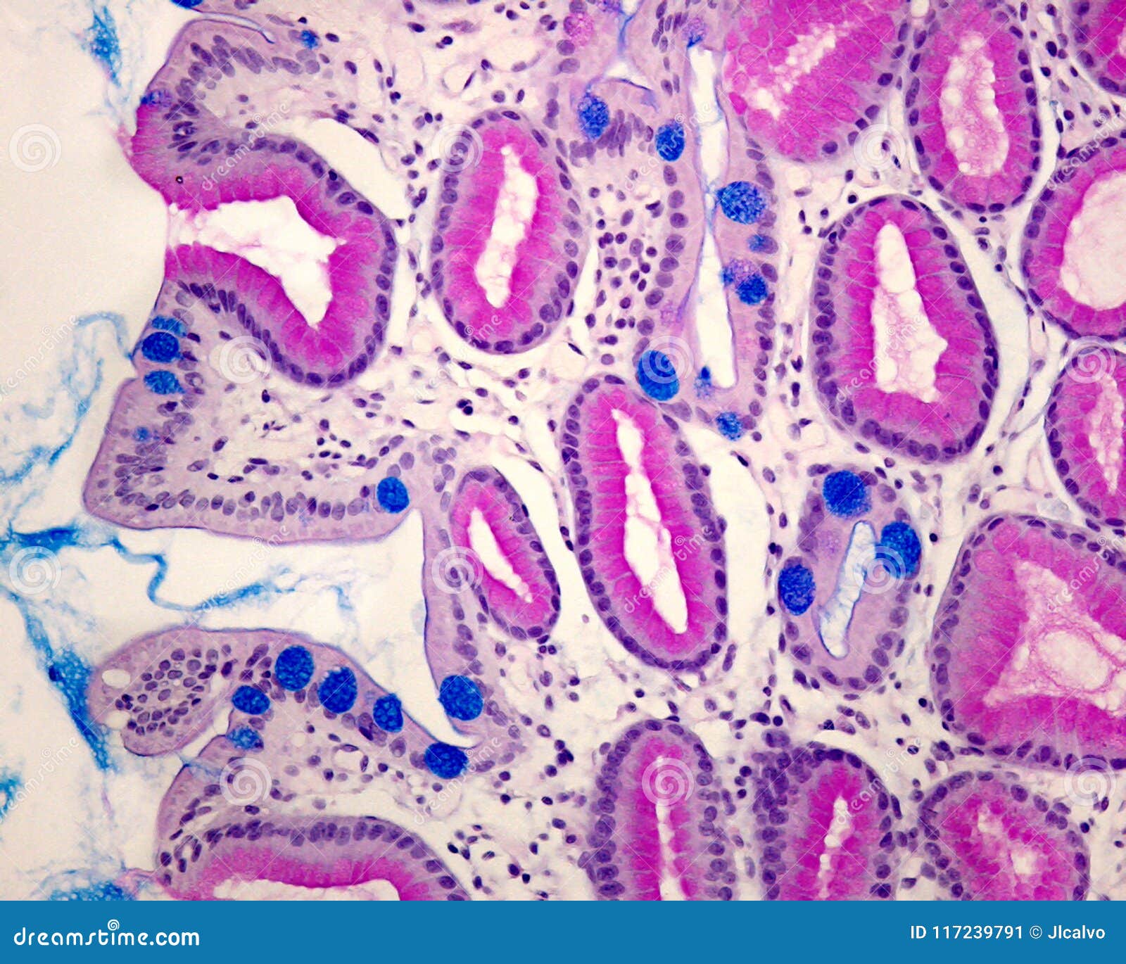 Metaplasia Intestinal De Muqueuse Gastrique Image stock - Image du ...