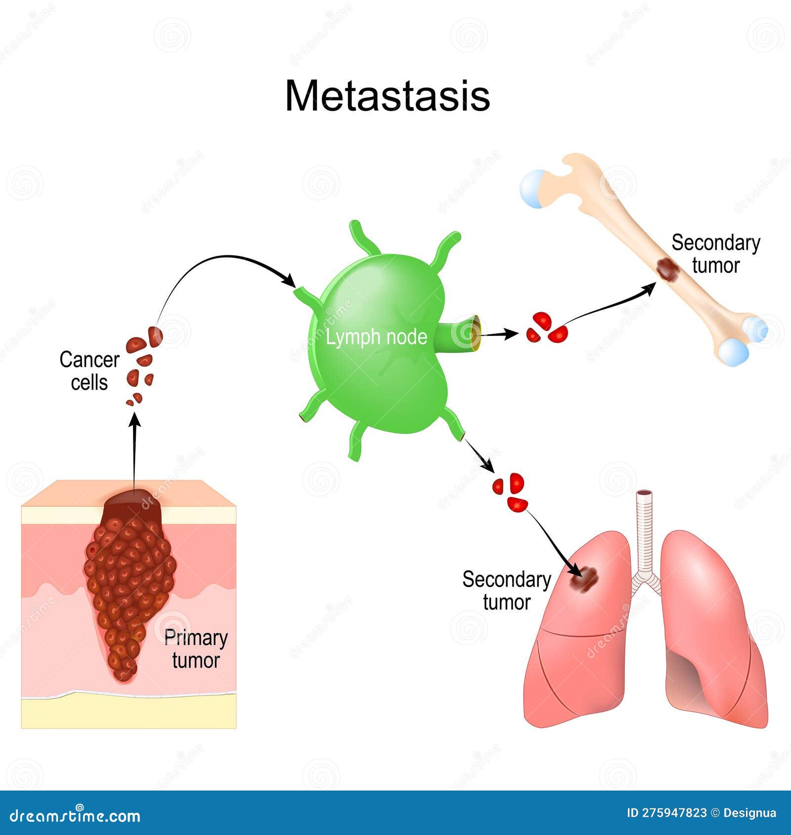Metastasis. Cancer Invasion. Malignant Tumor Stock Illustration ... Metastasis. Cancer Invasion. Malignant Tumor Stock Illustration ...