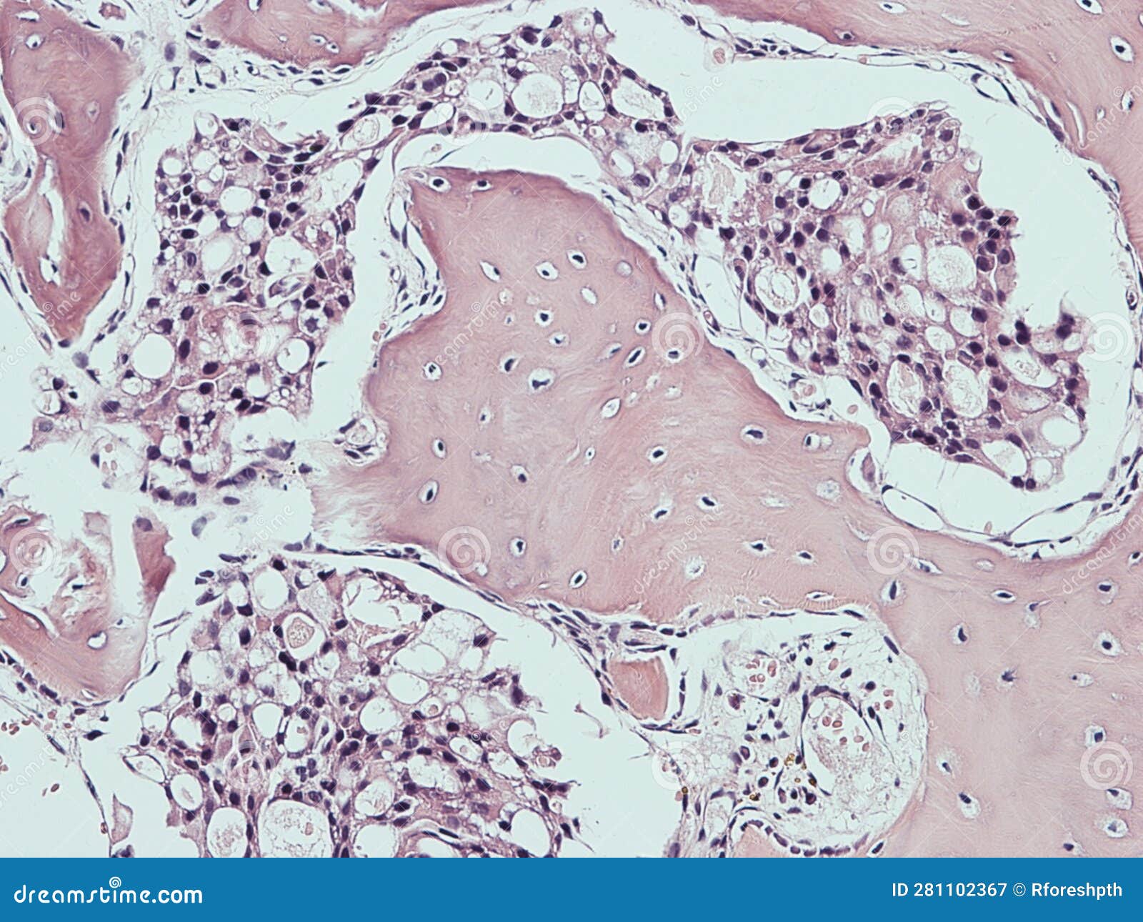 Metastasis Of Prostate Cancer In Bone Marrow Stock Image Image Of Prostate Osteoblast 281102367