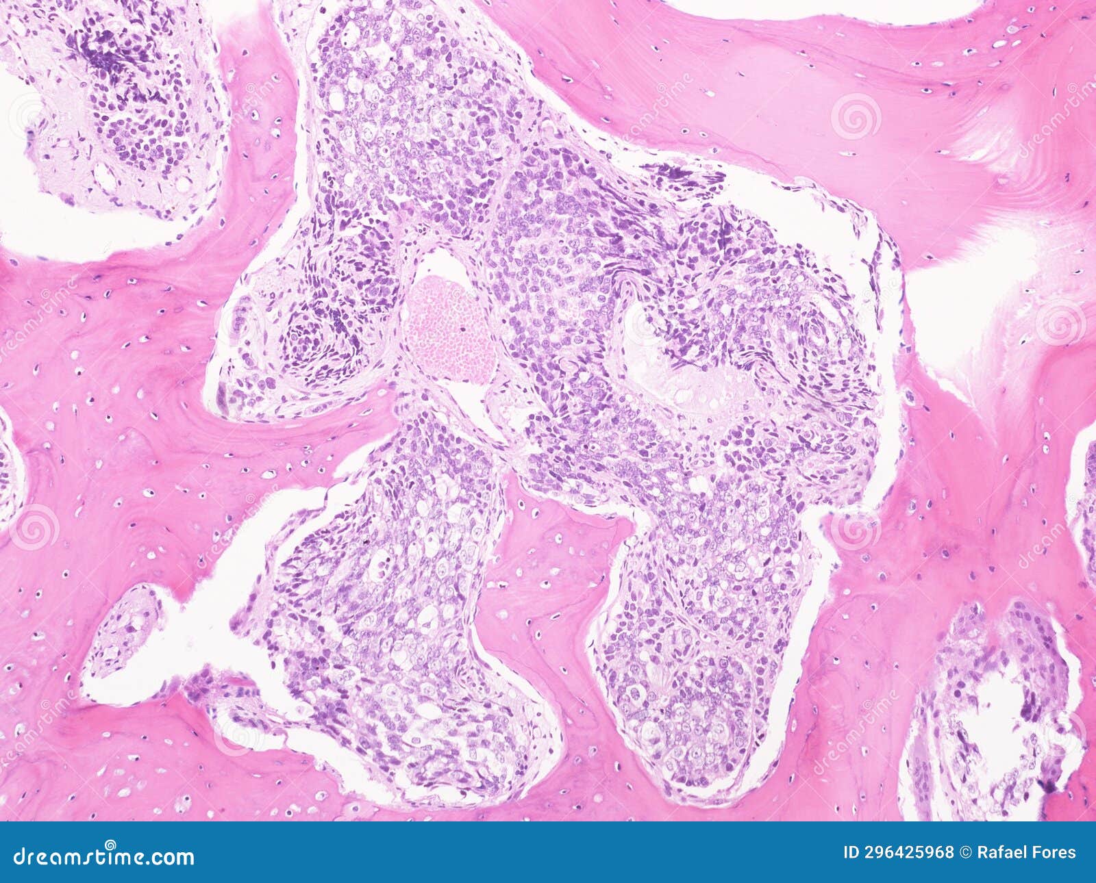 Biology Pictures Prostate Cancer Cells In The Bone Marrow