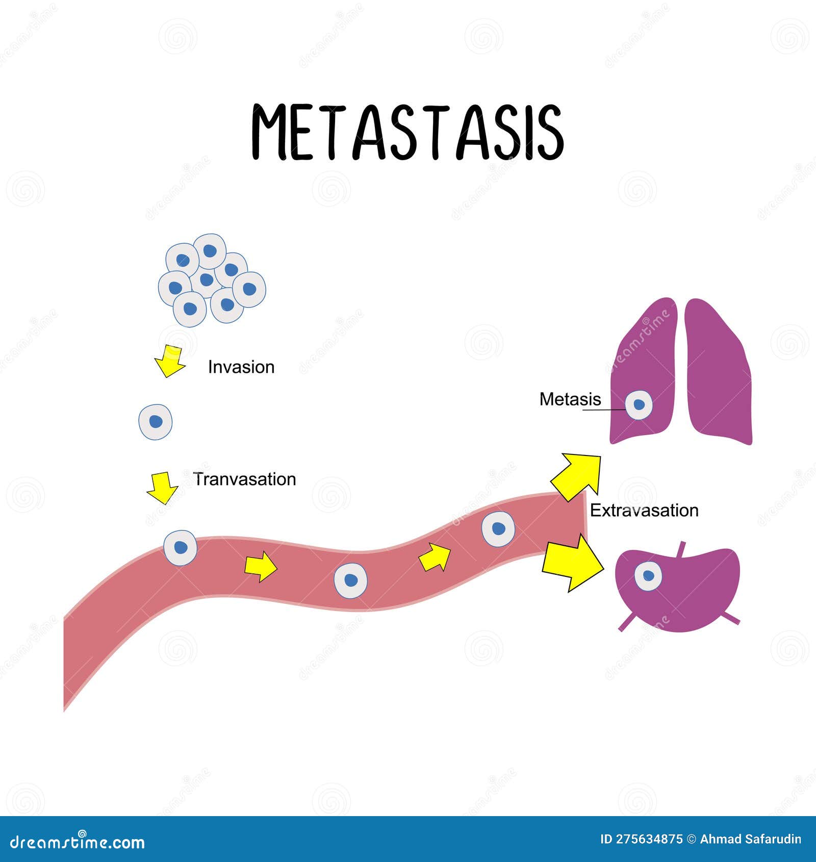 Metastasis: The Spread Of Cancer Cells From The Original Tumor To Other ... Metastasis: The Spread Of Cancer Cells From The Original Tumor To Other ...