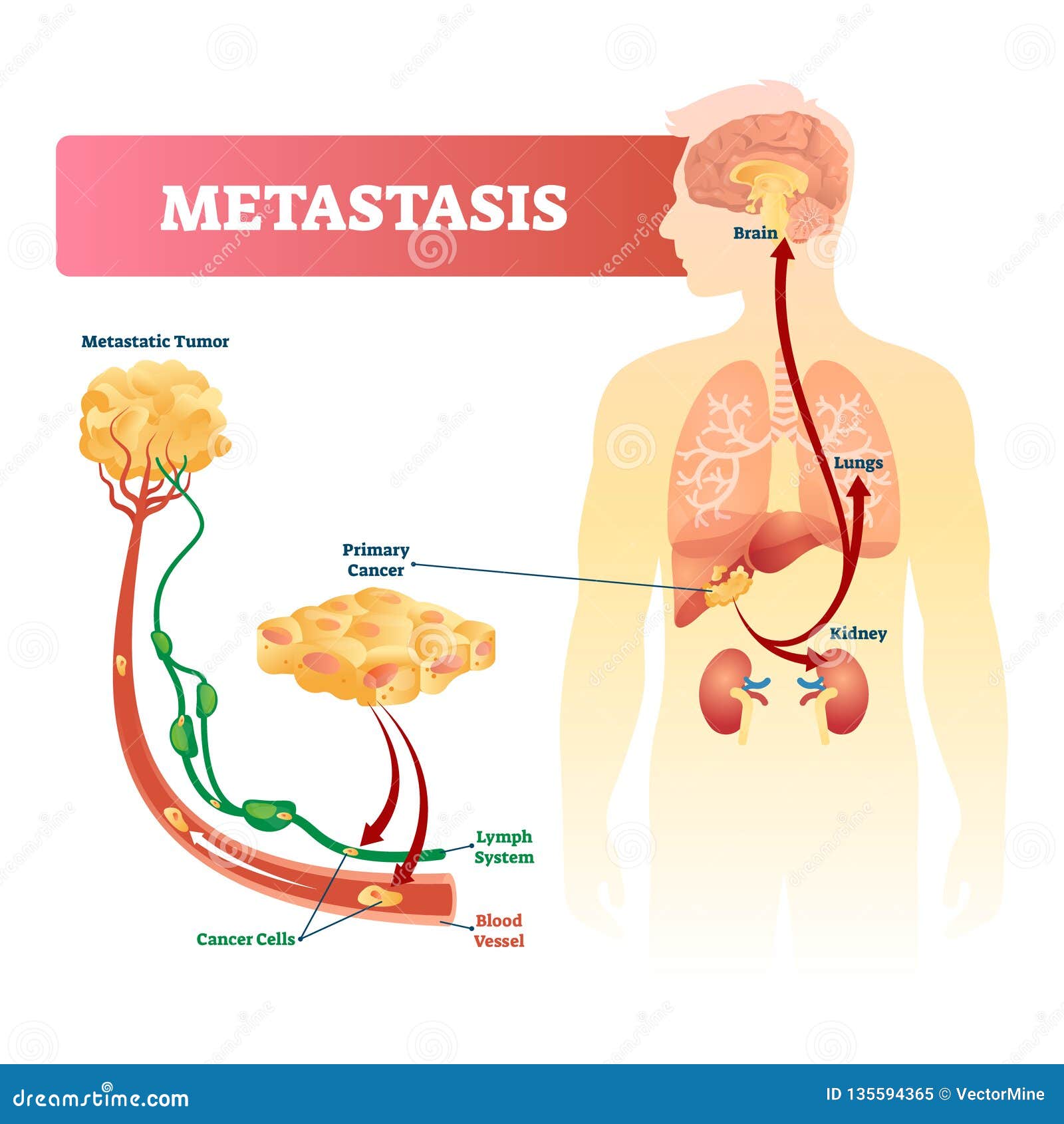 Metastasis Vector Illustration. Primary Cancer and Tumor Labeled ... Metastasis Vector Illustration. Primary Cancer and Tumor Labeled ...