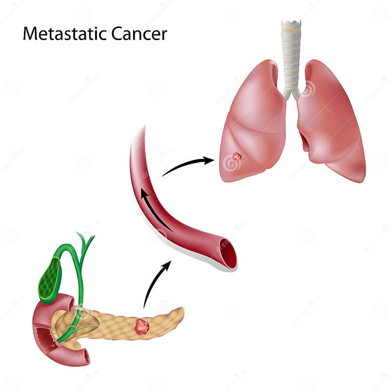 Metastatic cancer stock vector. Illustration of science - 25707841